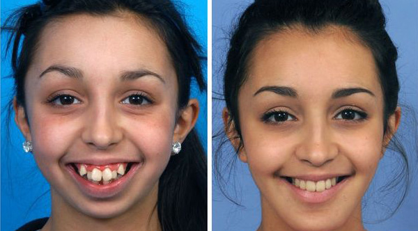 This Young Woman Had Surgery For A Rare Facial Condition. Her ...